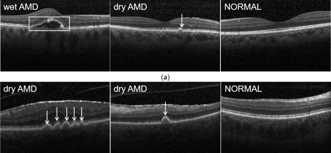 Macular Degeneration — Insight Ophthalmology