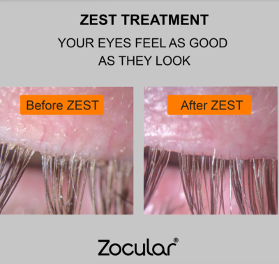 Zocular Treatment - Dr. Luna Xu
